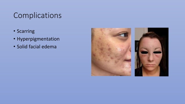 Acne dermatology 1.pptx