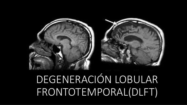 Demencia Frontotemporal