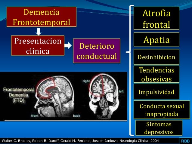 Demencia frontotemporal