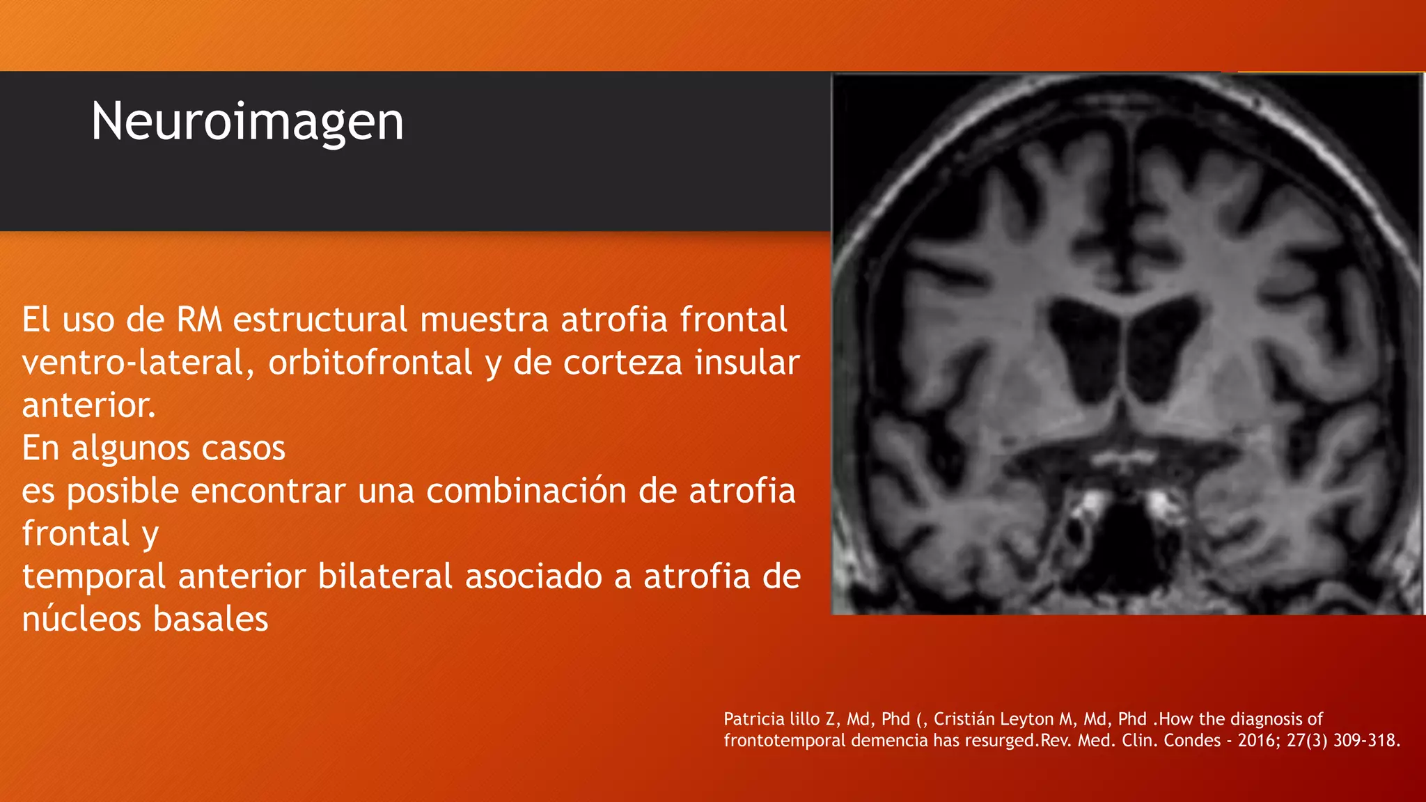 DEMENCIA FRONTO TEMPORAL.pptx