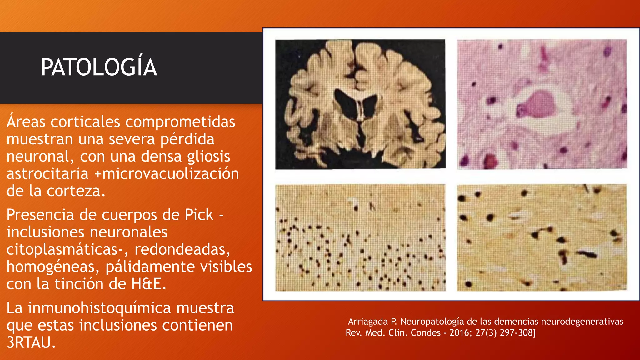 DEMENCIA FRONTO TEMPORAL.pptx