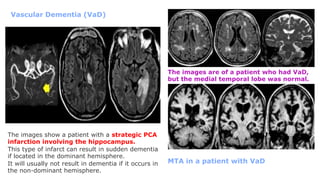 Dementia | PPTX