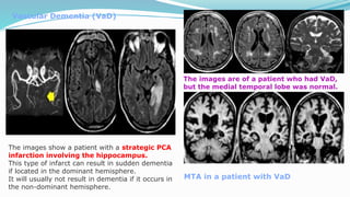dementia-presentation, types causes, physiotherapy management | PPTX