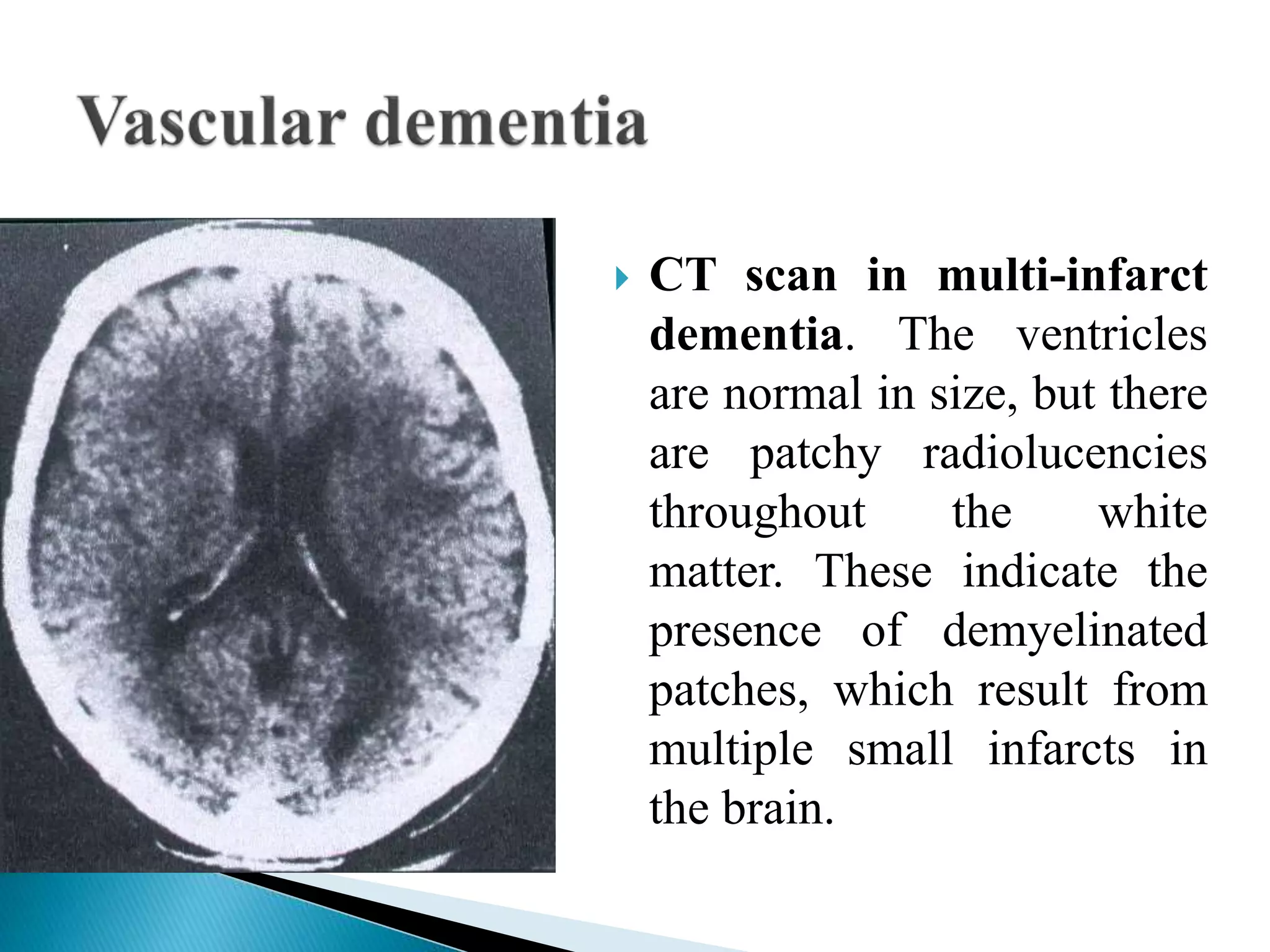 Dementia | PPTX
