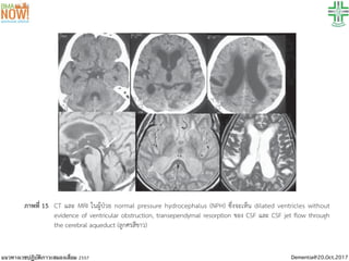 Dementia 20 oct2017 | PDF