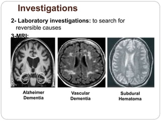 Dementia for Students | PPTX