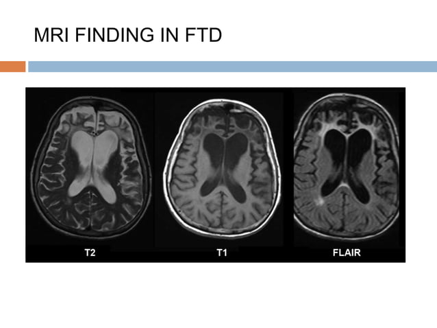 Approach to Dementia | PPT