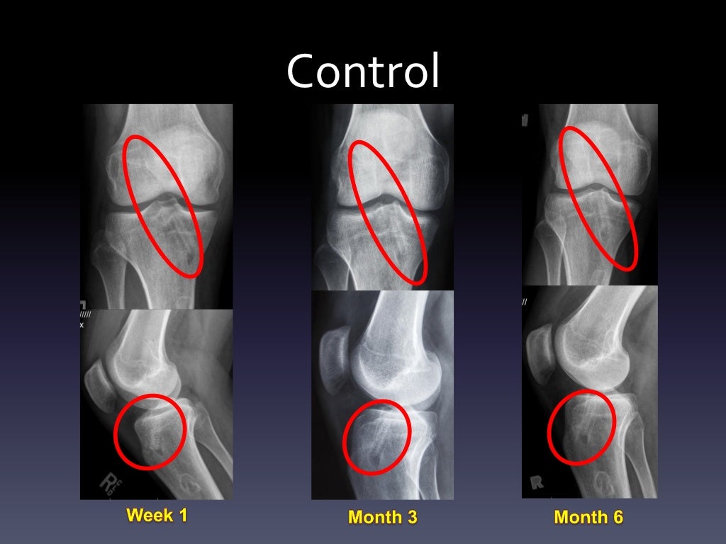 Demineralized Bone Matrix