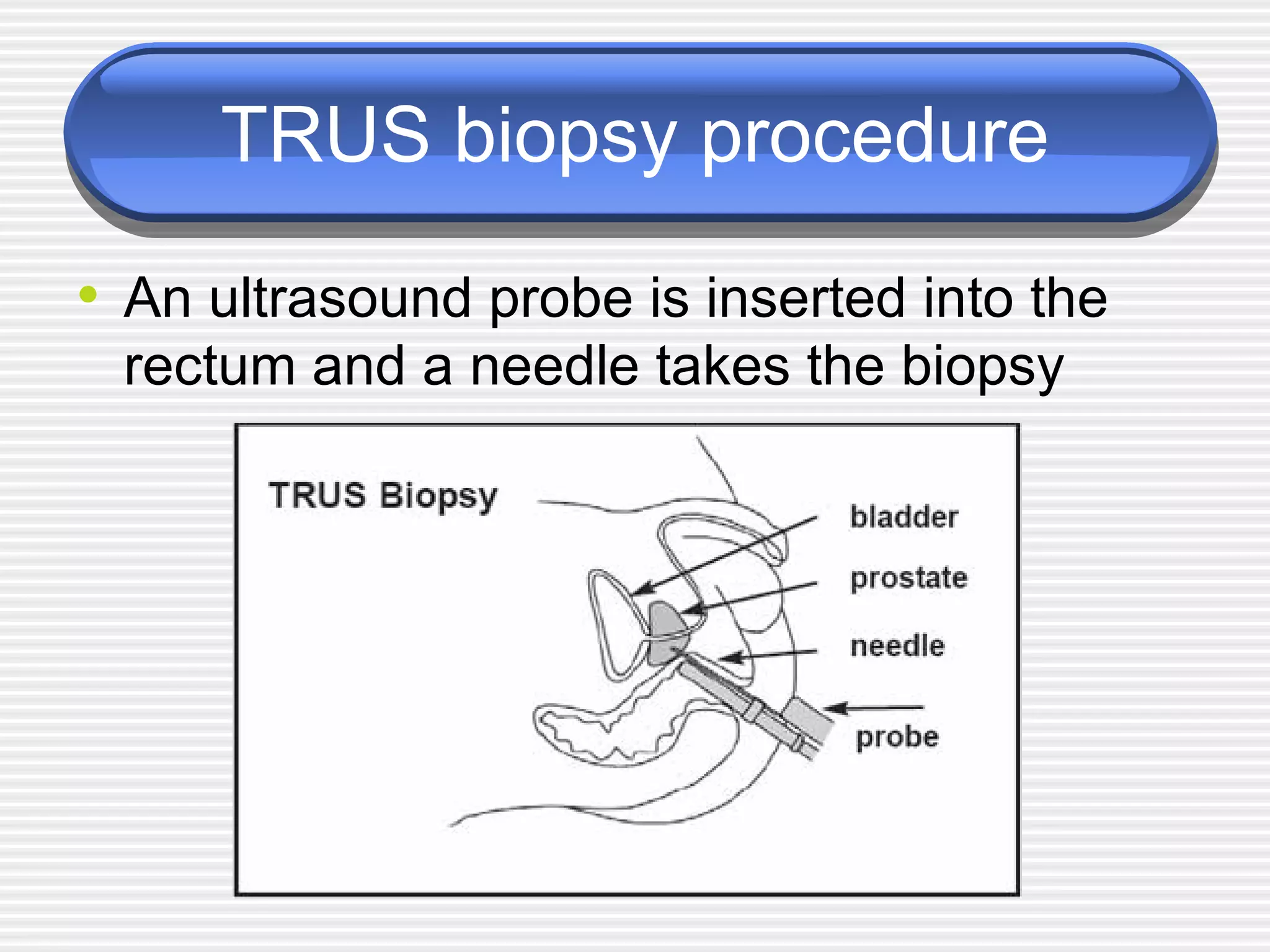 Demo 1 - Prostate Cancer TRUS biopsy | PPT