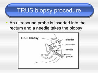 Demo 1 - Prostate Cancer TRUS biopsy | PPT