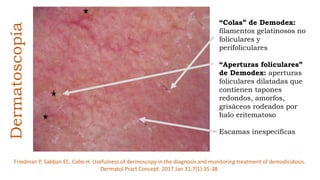 Demodicosis (Demodecidosis) | PPTX