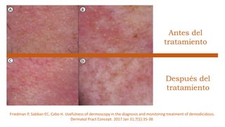 Demodicosis (Demodecidosis) | PPTX