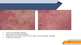 DEMODECIDOSIS MARIA ROCHA DERMATO.pptx
