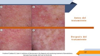 DEMODECIDOSIS MARIA ROCHA DERMATO.pptx