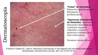 demodex. GENERALIDADES Y ENFERMEDADES ASOCIADAS | PPTX