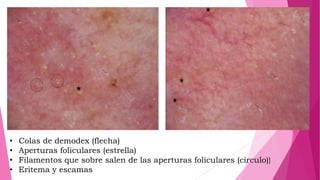 demodex. GENERALIDADES Y ENFERMEDADES ASOCIADAS | PPTX