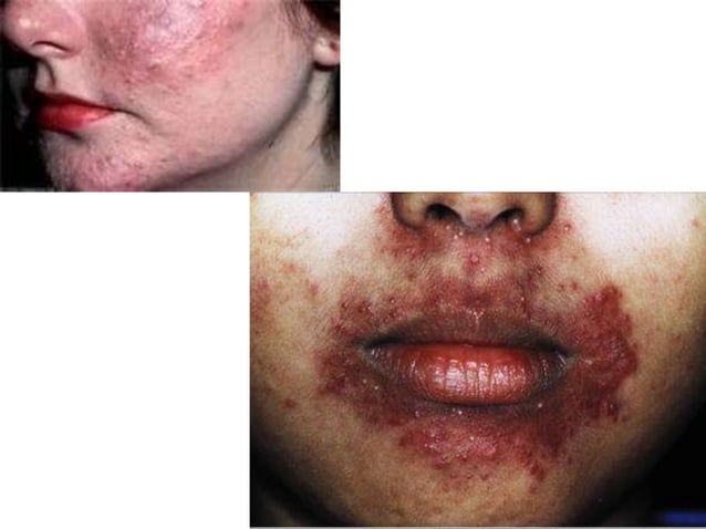 Demodex by aseem | PPTX