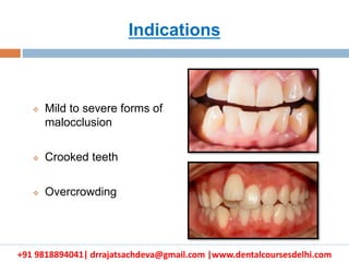 Demon braces| Ortho-dontic Treatment| Ortho-dontic Braces | PPT
