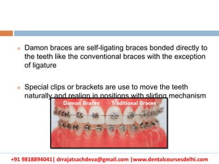 Demon braces| Ortho-dontic Treatment| Ortho-dontic Braces | PPT