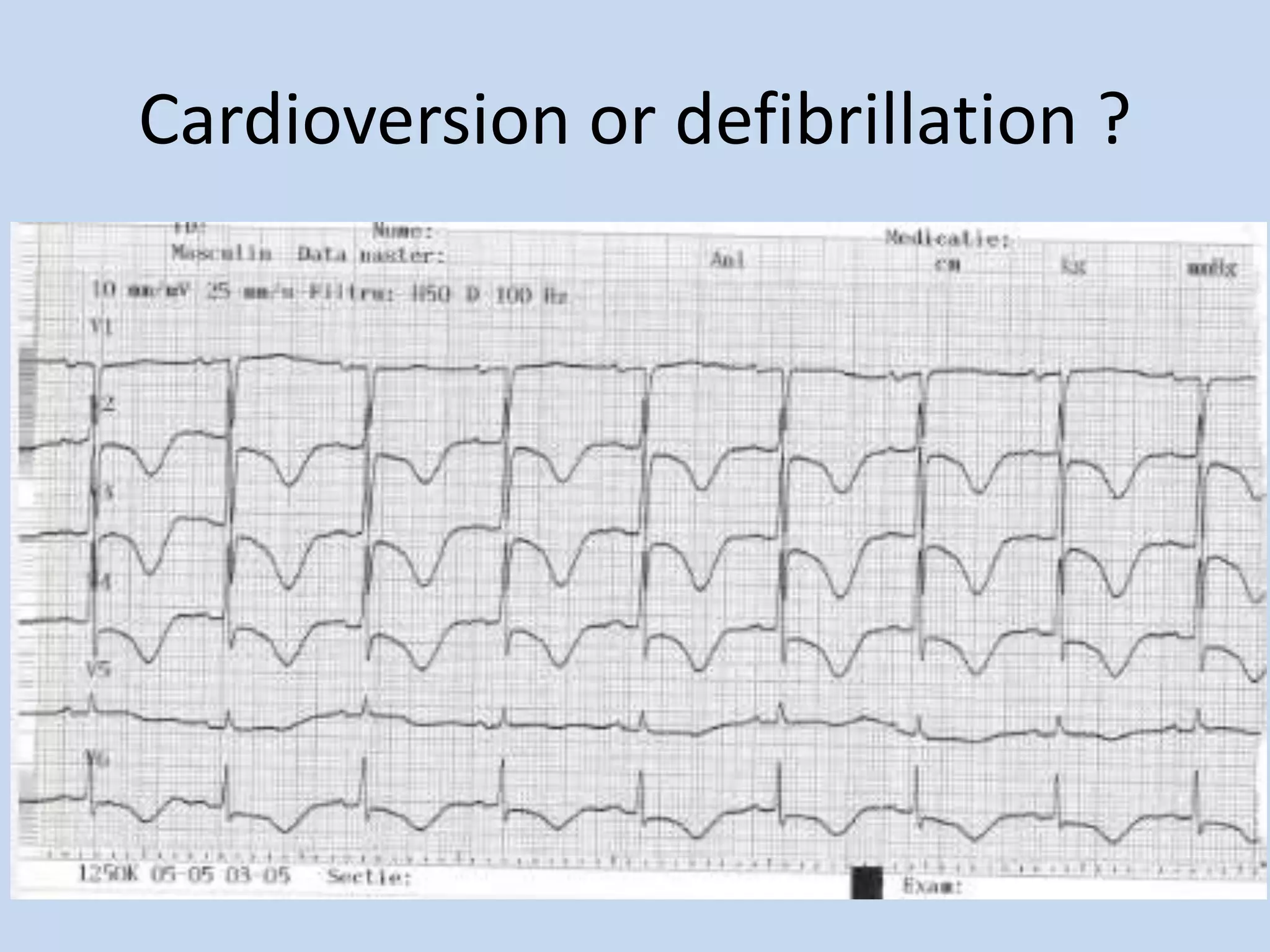 Cardioversion and Defibrillation | PPTX