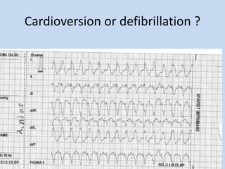 Cardioversion and Defibrillation | PPTX
