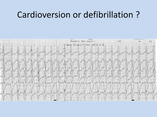 Cardioversion and Defibrillation | PPTX