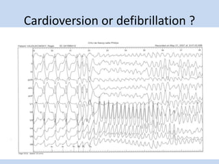 Cardioversion and Defibrillation | PPTX
