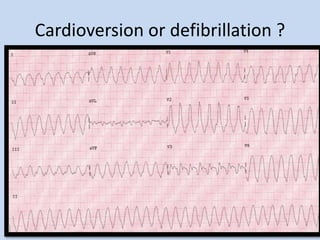 Cardioversion and Defibrillation | PPTX