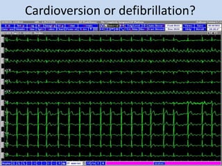 Cardioversion and Defibrillation | PPTX