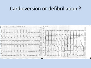 Cardioversion and Defibrillation | PPTX