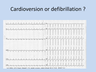 Cardioversion and Defibrillation | PPTX