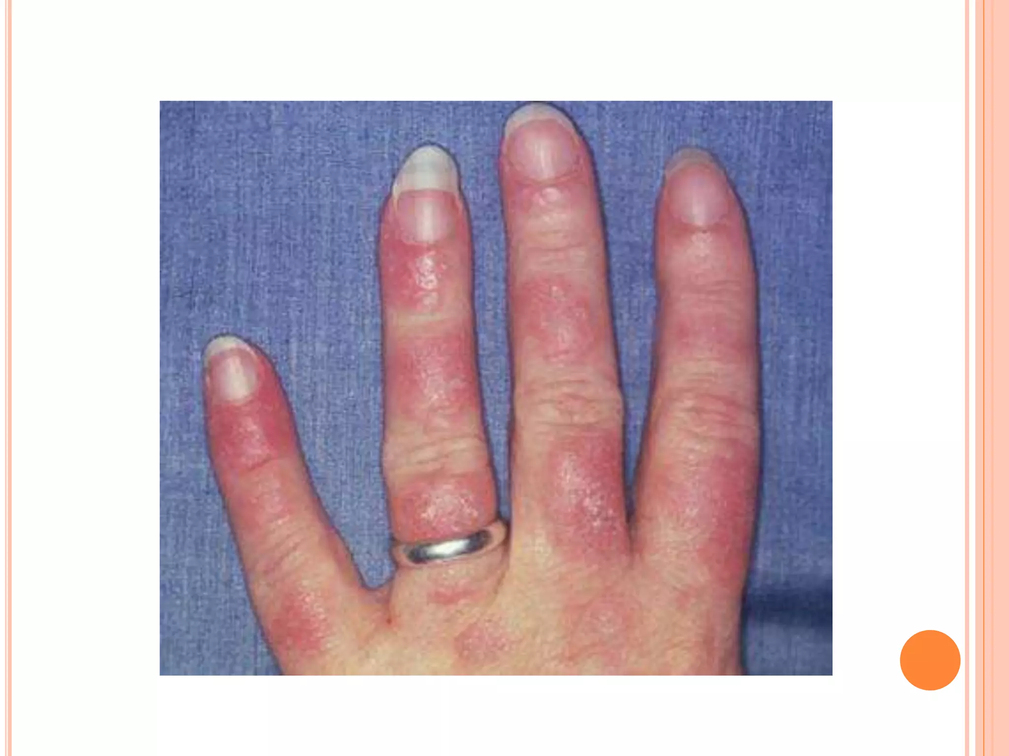 Demonstration of le cells | PPTX