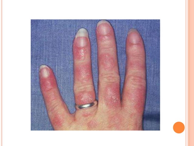 Demonstration of le cells | PPTX