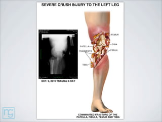 Demonstrative Evidence For Personal Injury Cases | PDF