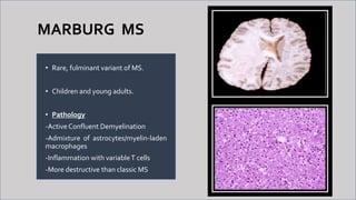 Demyelinating diseases of CNS | PPTX