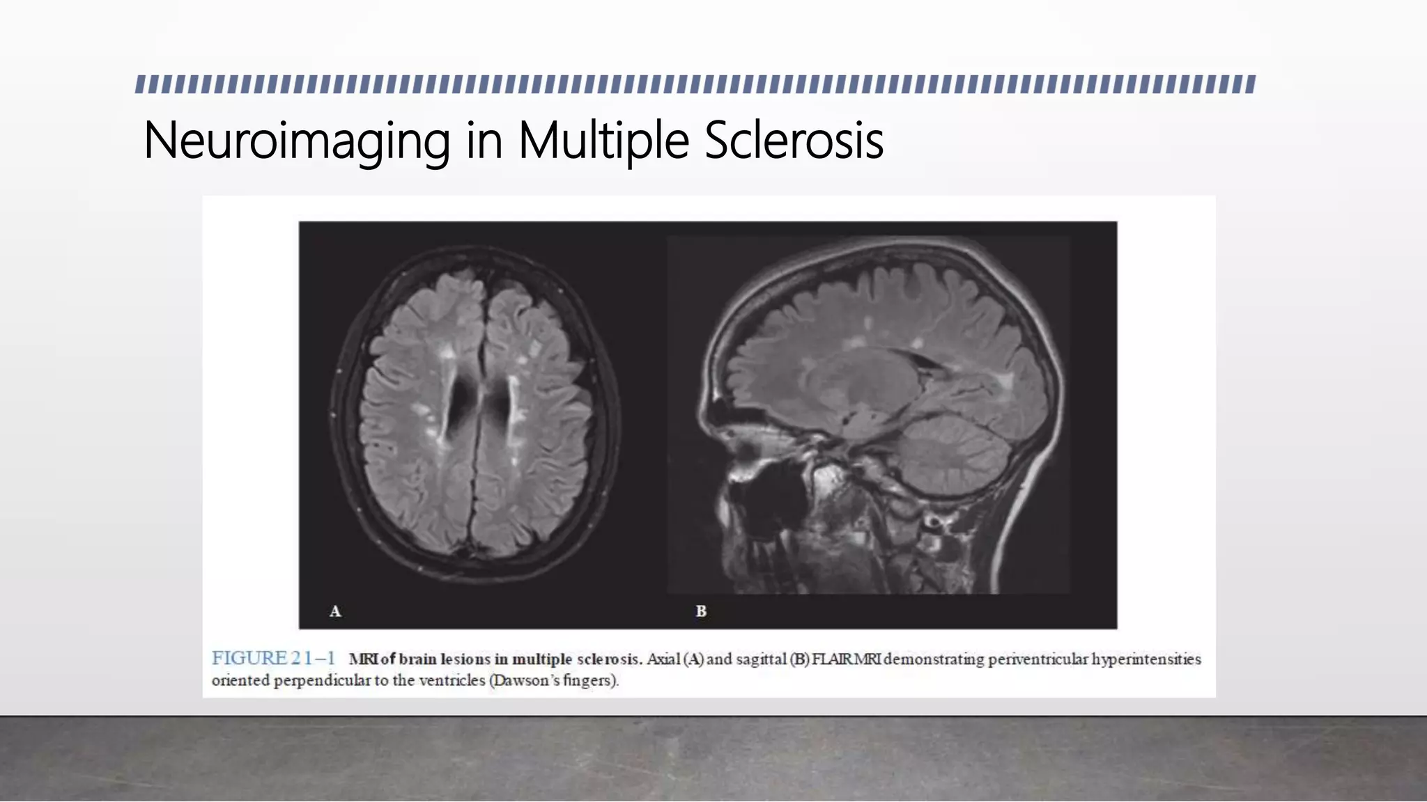Demyelinating diseases of the central nervous system | PPTX