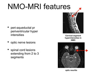 Demyelinating disorders approach | PPTX