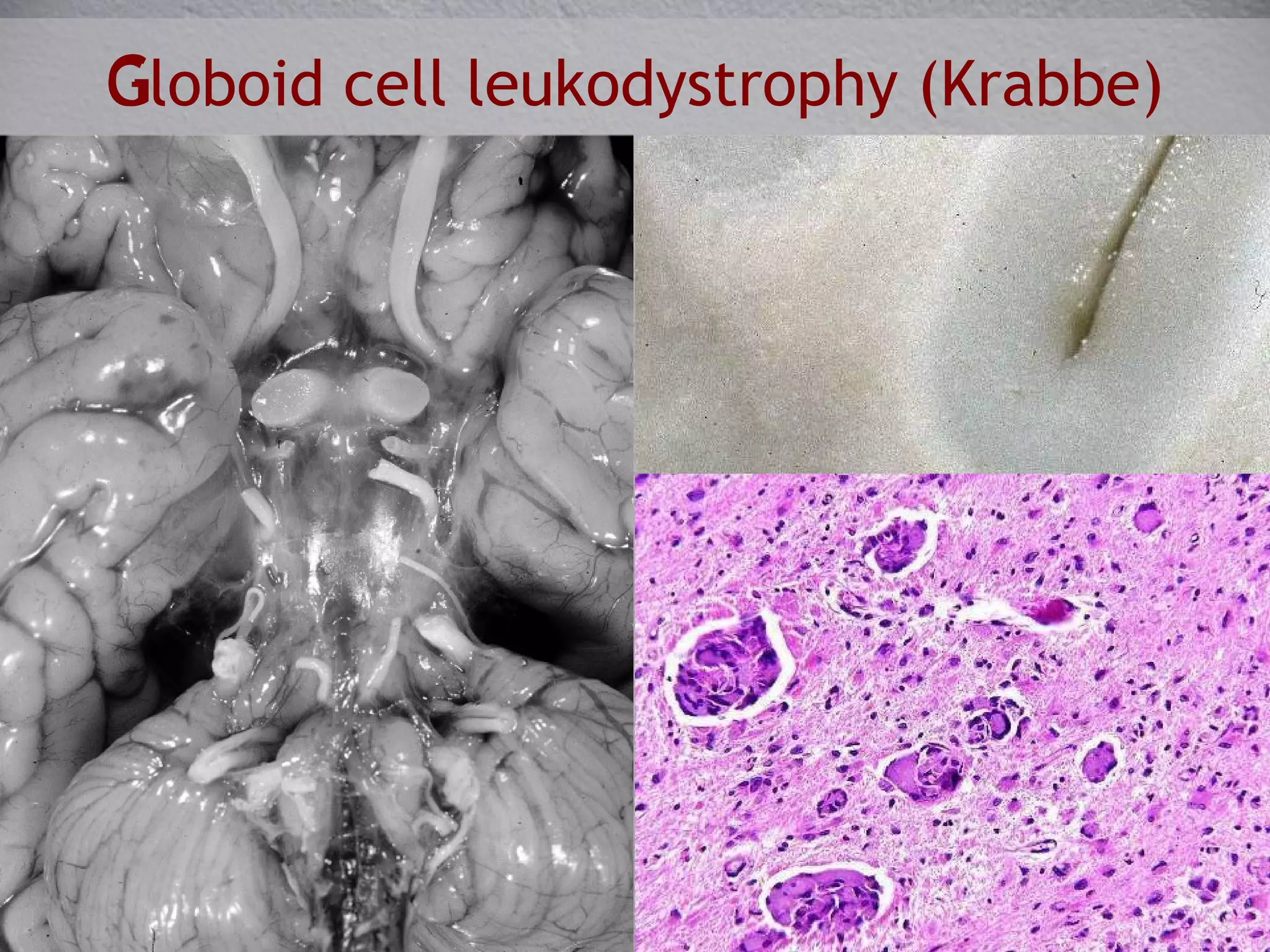 Pathology of Demyelinating Disease | PPT