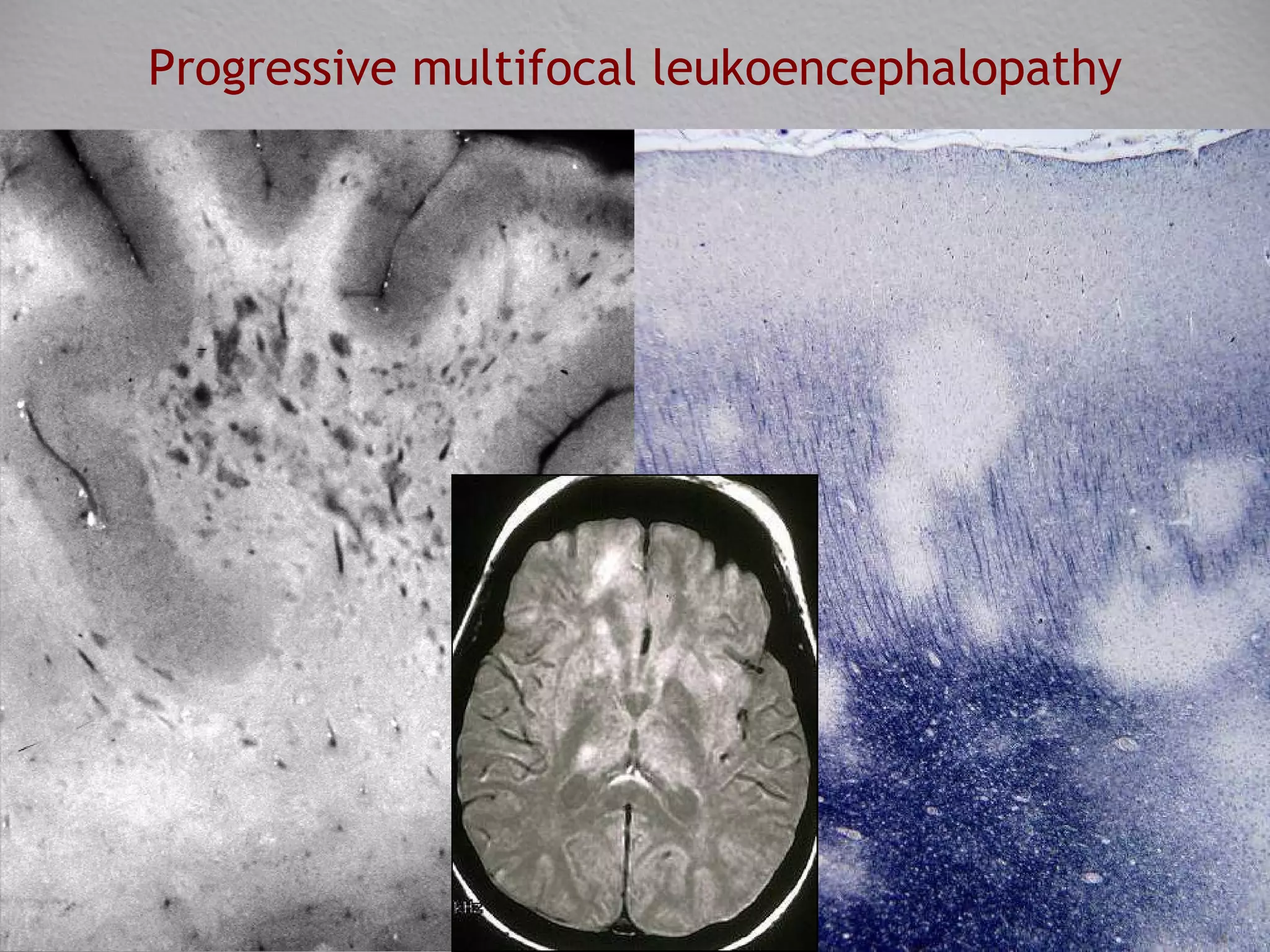 Pathology of Demyelinating Disease | PPT