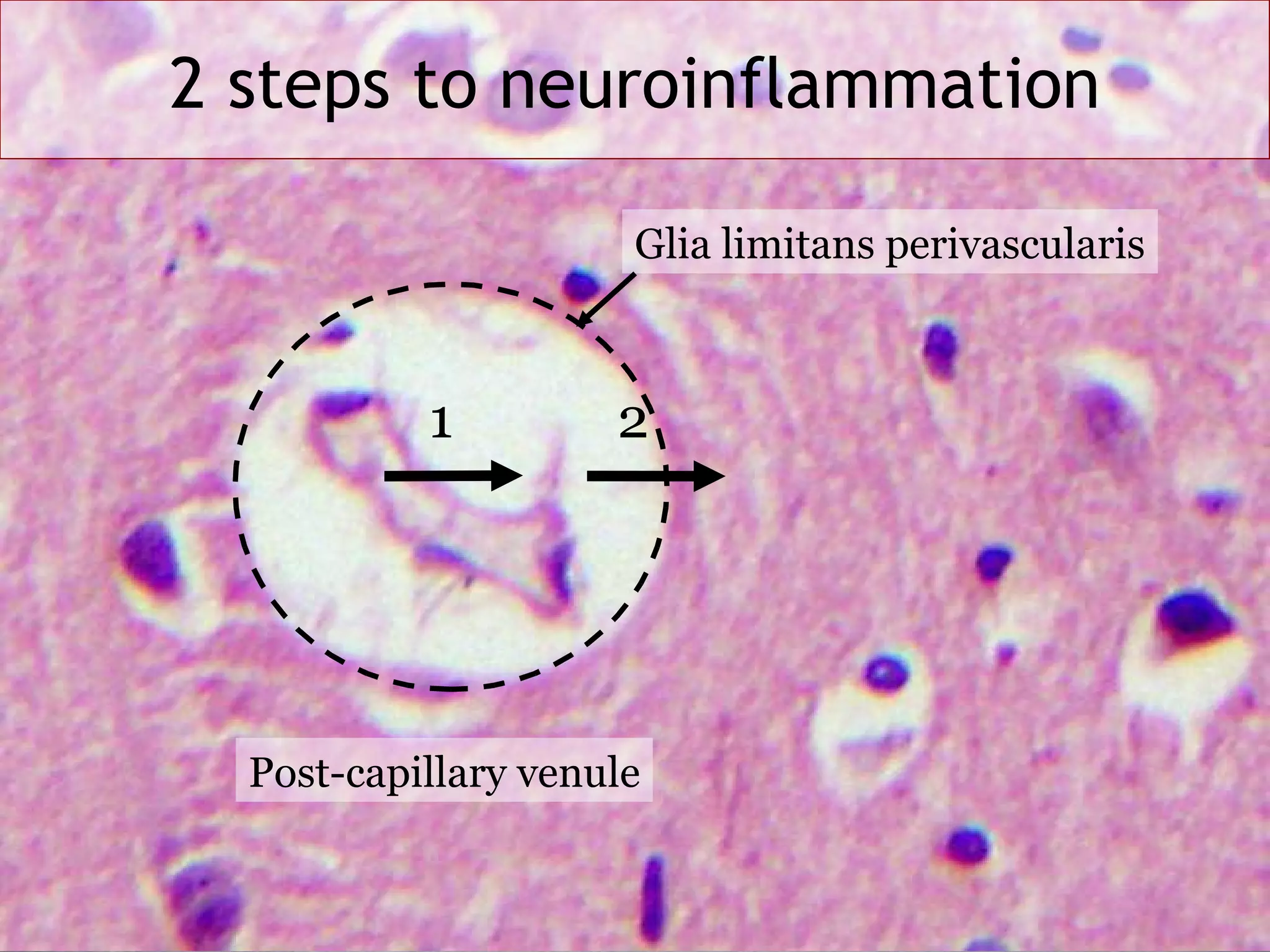 Pathology of Demyelinating Disease | PPT