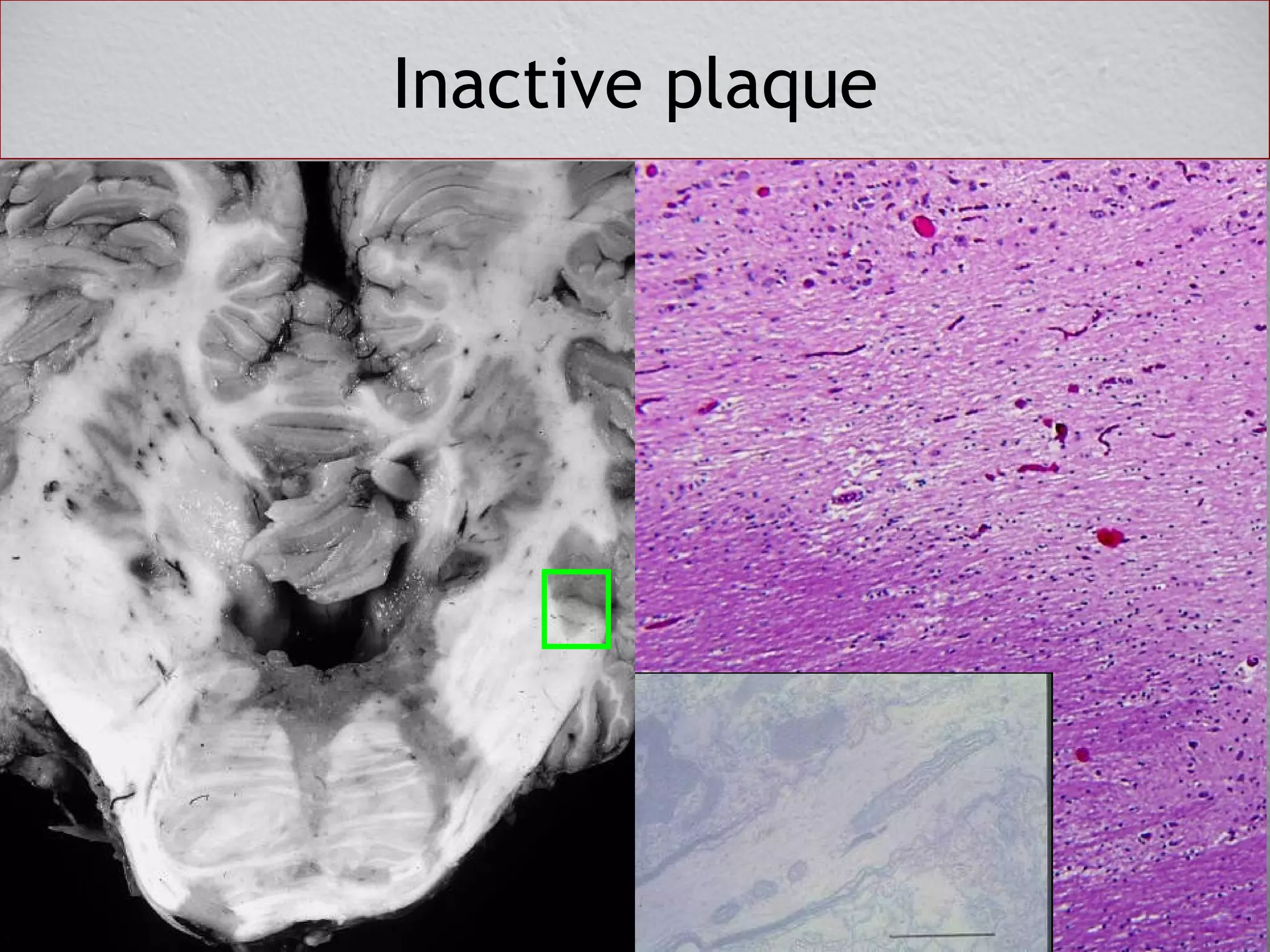 Pathology of Demyelinating Disease | PPT