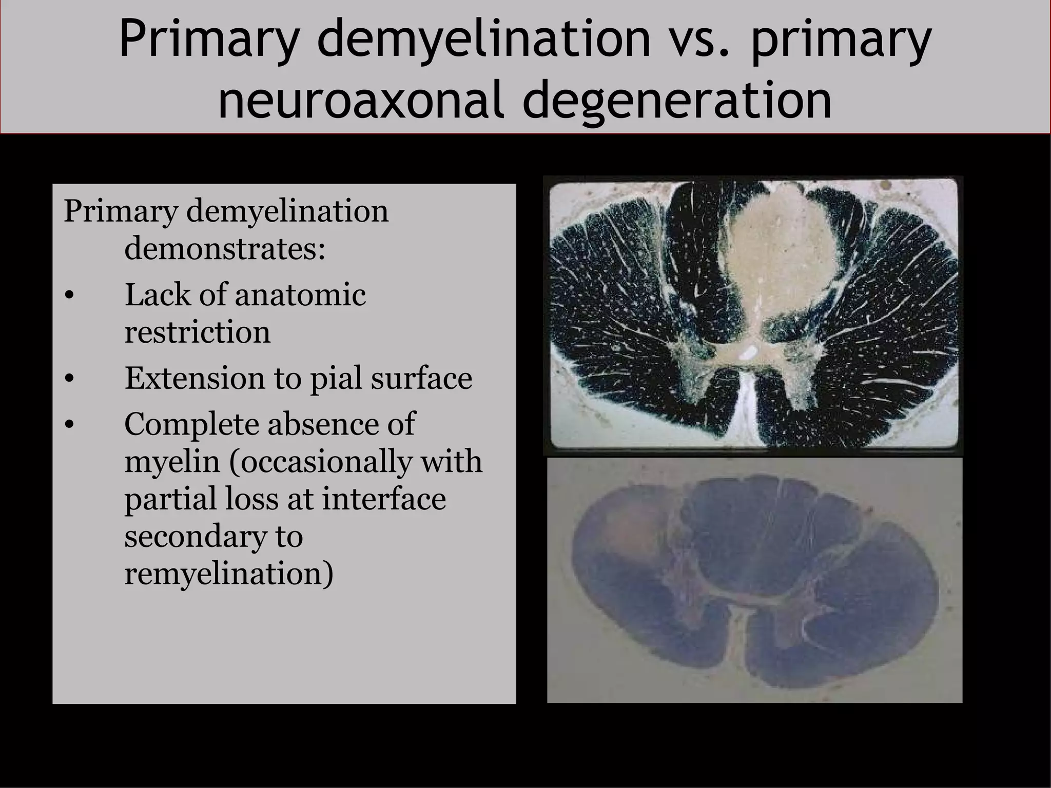 Pathology of Demyelinating Disease | PPT