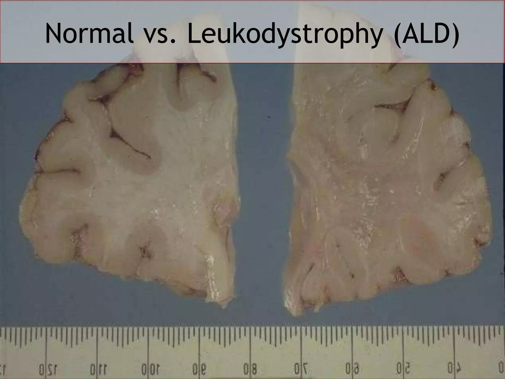 Pathology of Demyelinating Disease | PPT