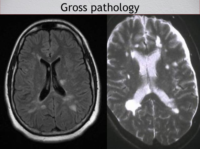 Pathology of Demyelinating Disease | PPT | Brain and Nervous System ...