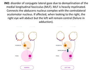 Demyelination by Dr Sabu Augustine | PPTX | Brain and Nervous System ...