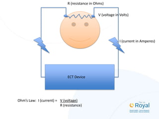 Electroconvulsive Therapy Diagram