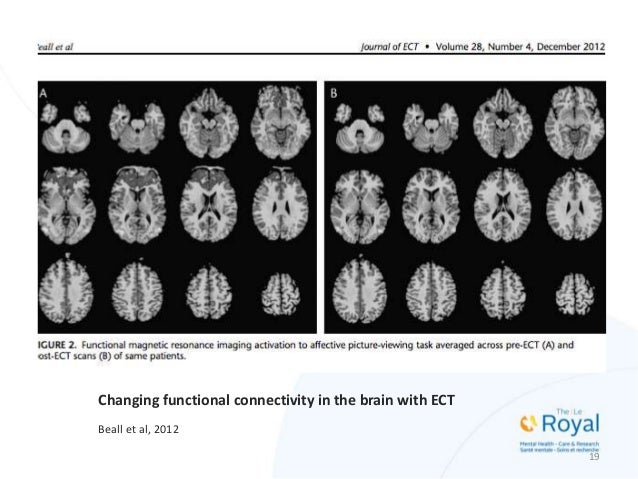 Demystifying Electroconvulsive Therapy (ECT)