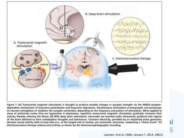 Demystifying Electroconvulsive Therapy (ECT)