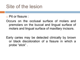 Denatal caries - Tooth decay | PPTX
