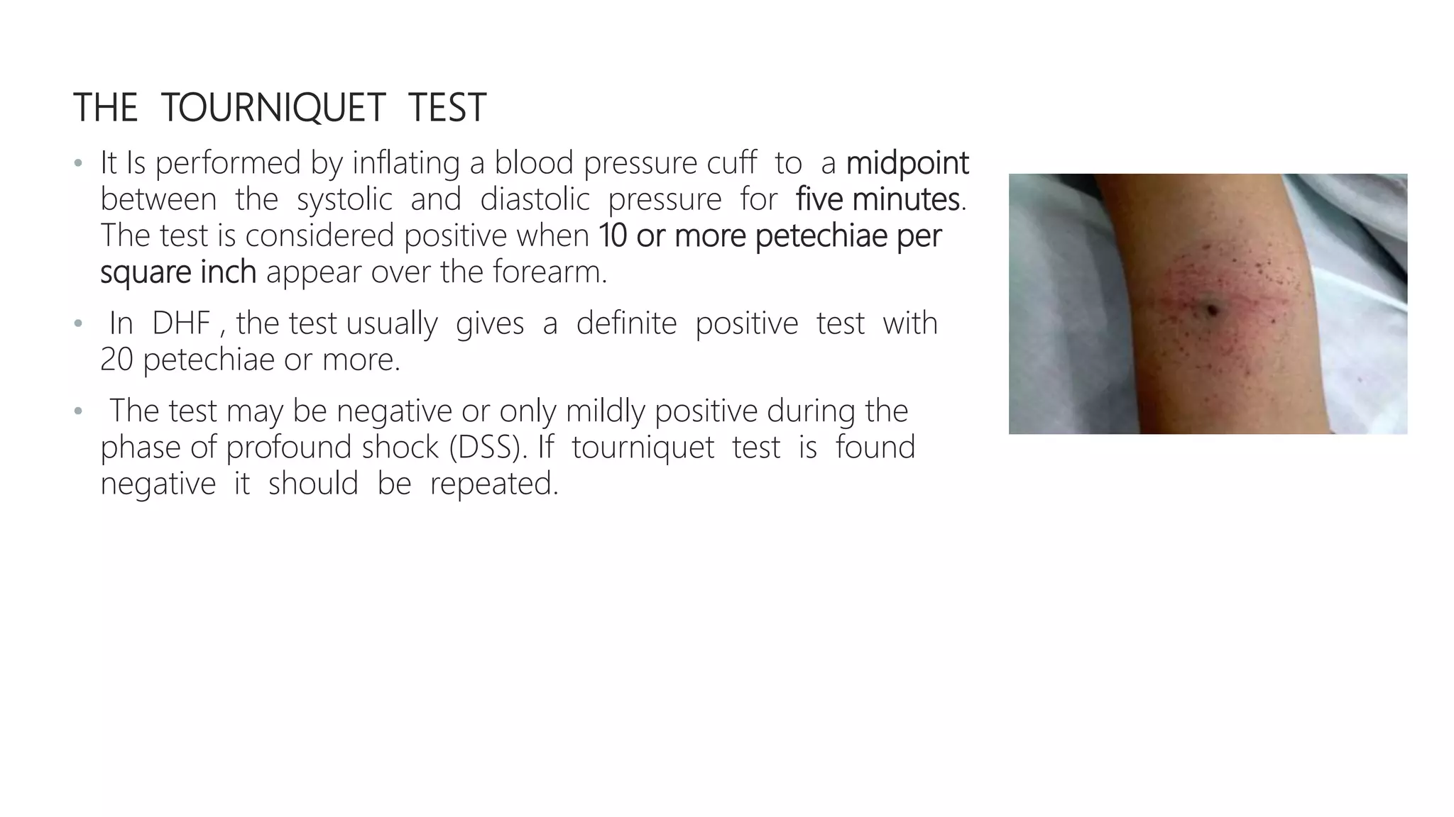 Dengue Fever - Brief Description, Diagnosis and Management | PPTX